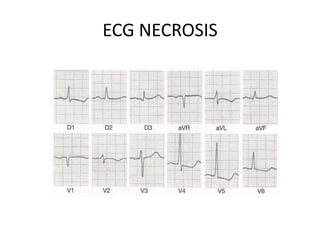 Ecg necrosis | PPT