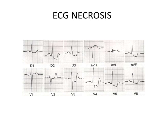 Ecg necrosis | PPT