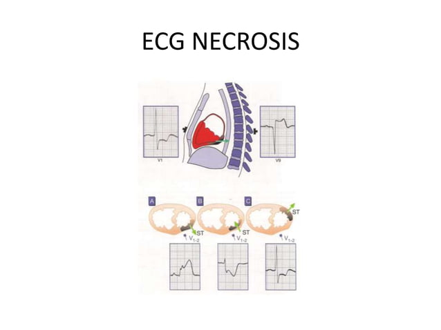 Ecg necrosis | PPT