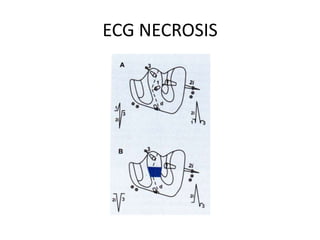 Ecg necrosis | PPTX