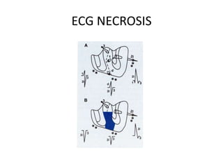 Ecg necrosis | PPTX