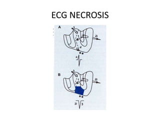 Ecg necrosis | PPT