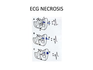 Ecg necrosis | PPTX