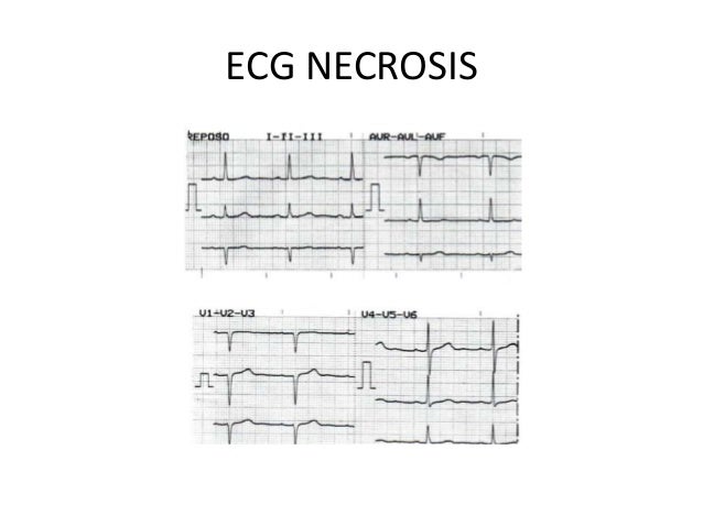 Ecg necrosis