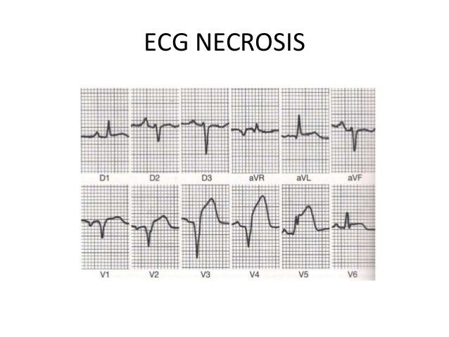 Ecg necrosis