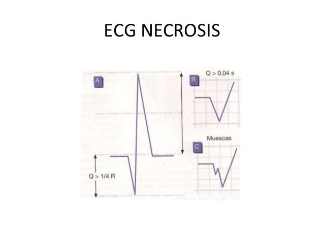 Ecg necrosis