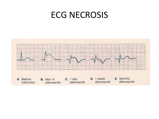 Ecg necrosis
