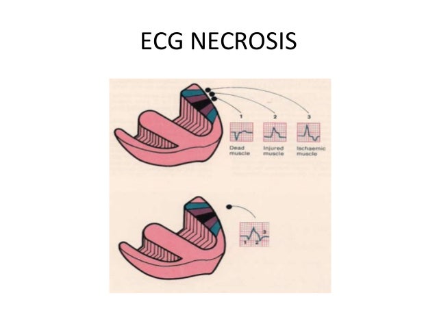Ecg necrosis