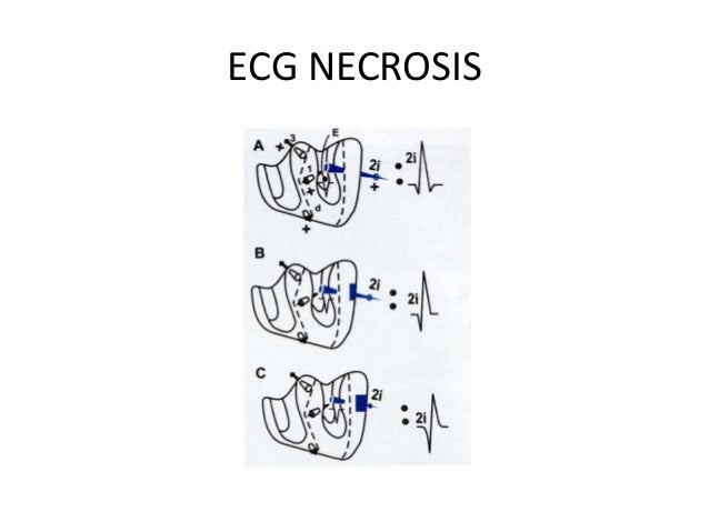 Ecg necrosis