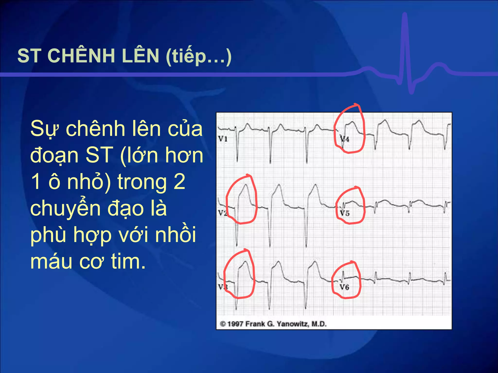 Ecg nhoi mau co tim | PDF