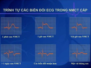 Ecg nhoi mau co tim | PDF