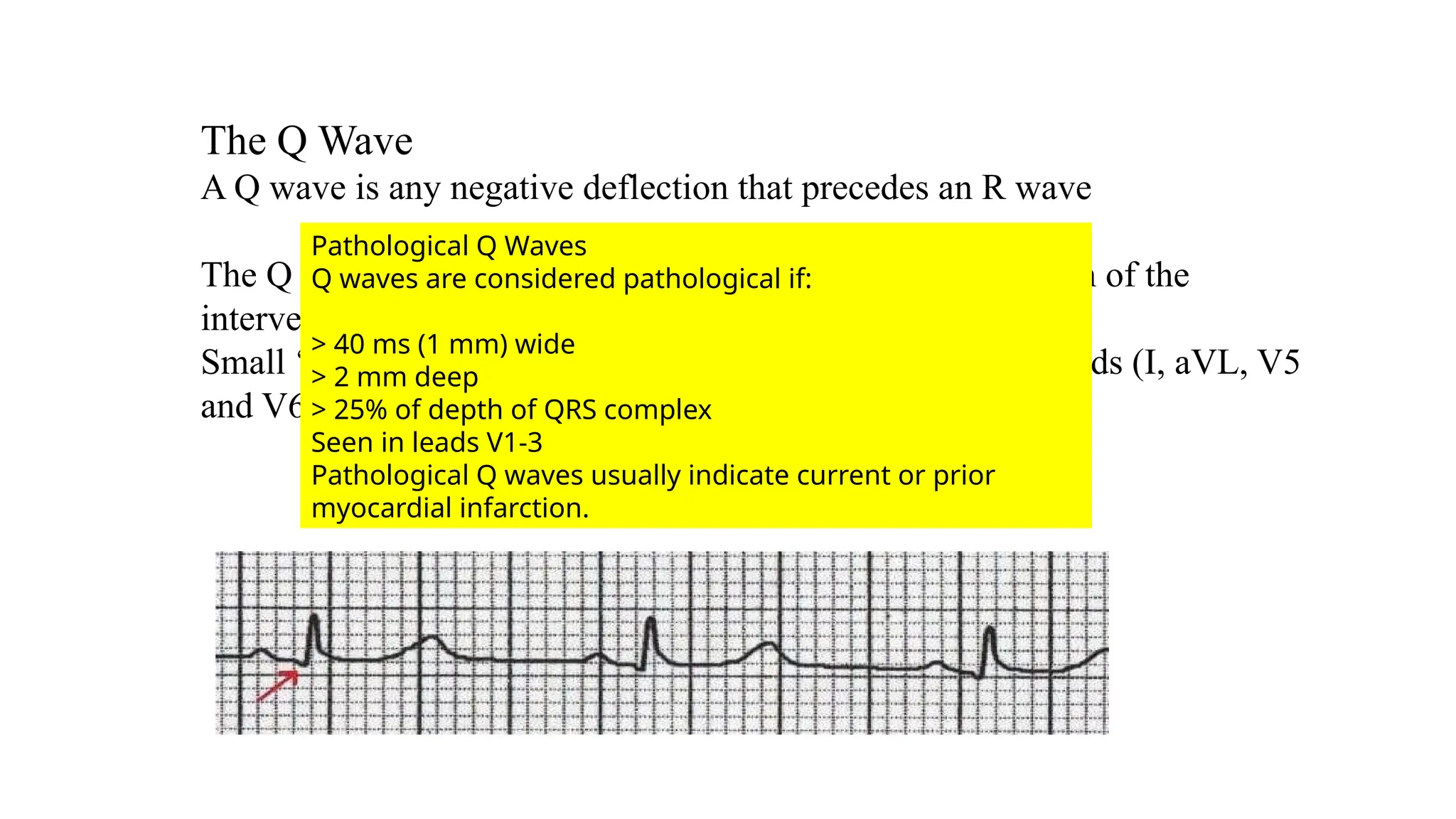ELECTROCARDIOGRAM FOR MEDICAL STUDENTS IN SIMPLE | PPTX