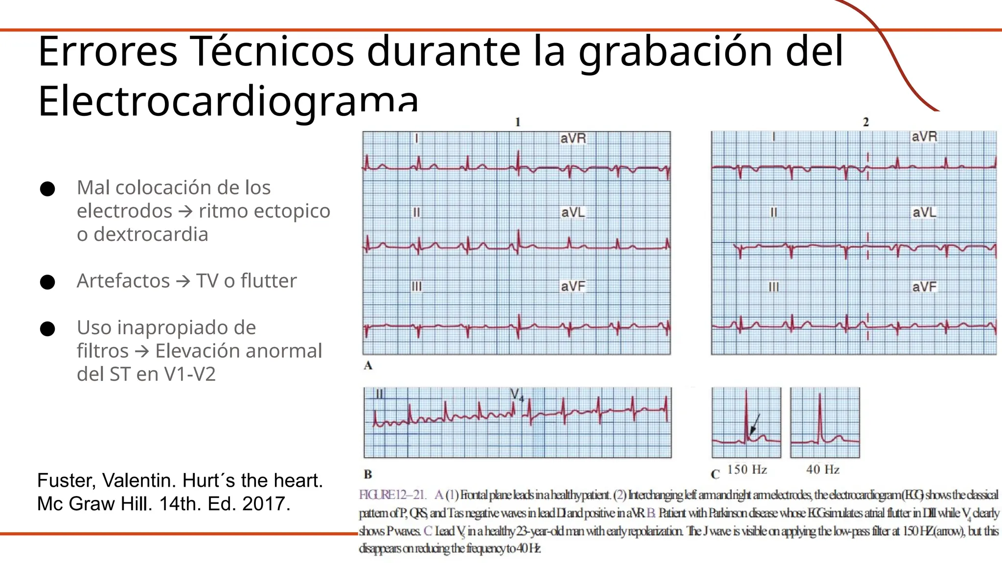 Electrocardiograma normal, PAra prinicpiantes | PPT