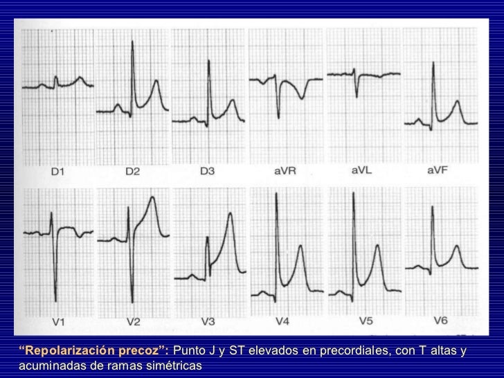 Intervalo pr electrocardiograma - rodenclassifieds