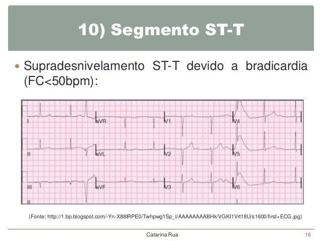 Ecg normalidade e variação de normalidade