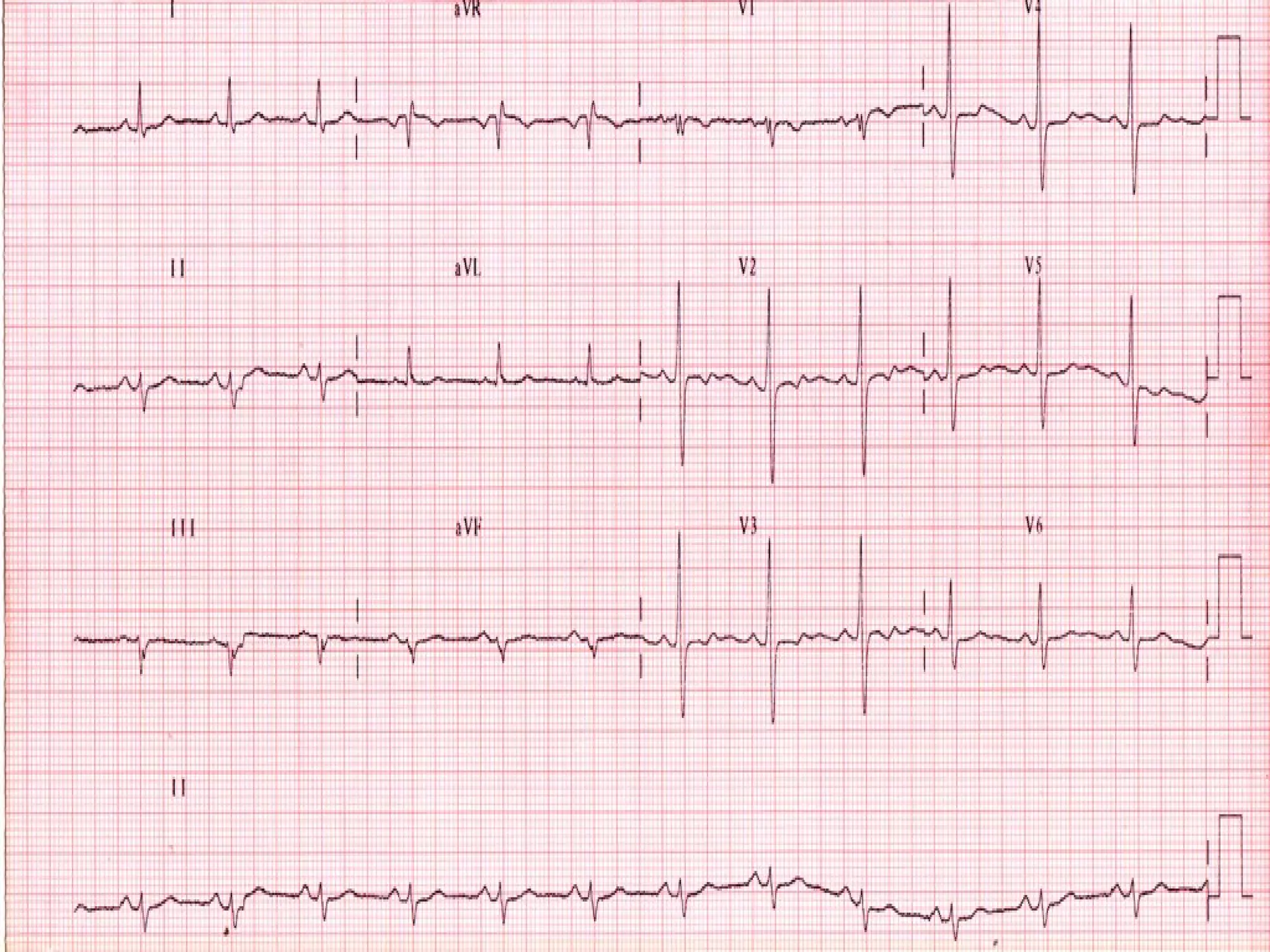 ECG Normal Dr. Olivera Parte 2 | PPT