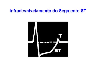 ECG NORMAL | PPT