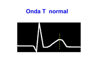ECG NORMAL | PPT