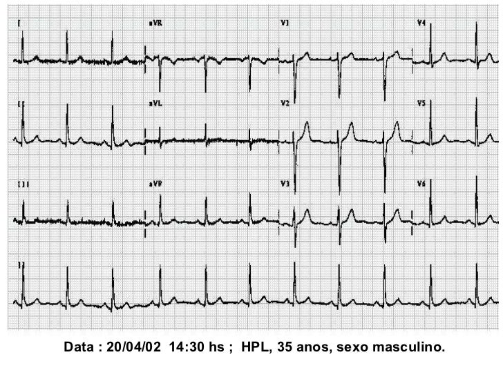ECG NORMAL