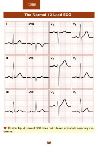 Normal 12 Lead Ecg Labeled