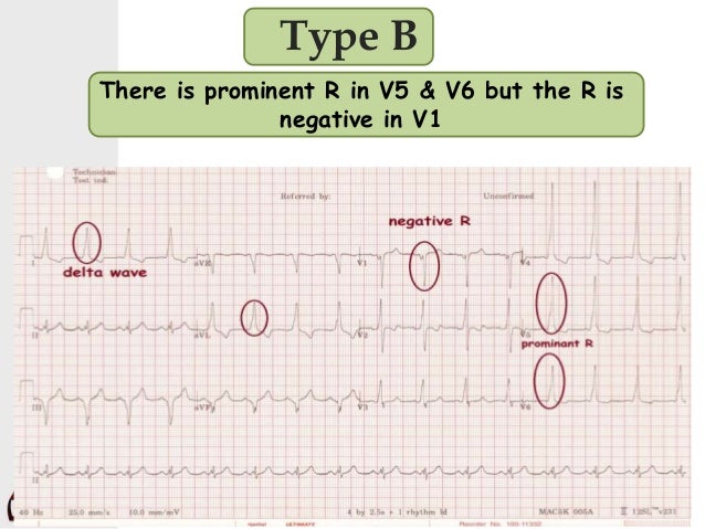 ECG Notes