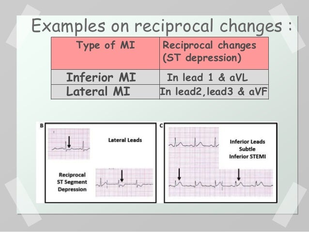 ECG Notes
