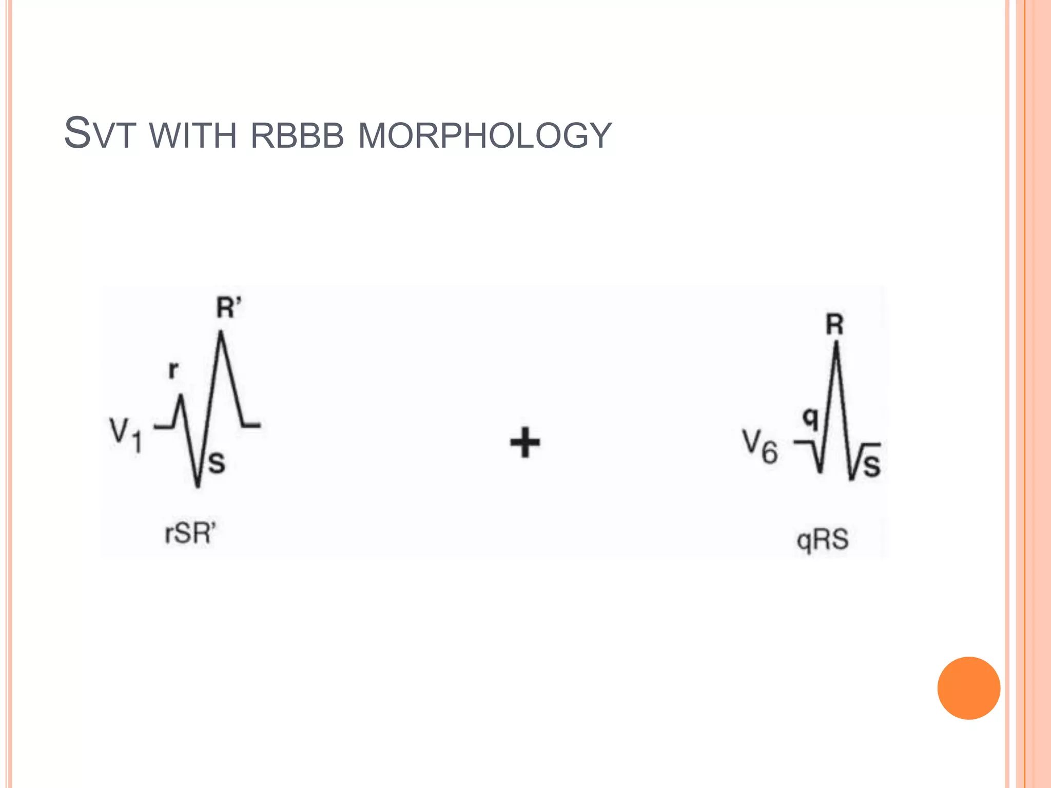 wide complex tachycardia | PPTX