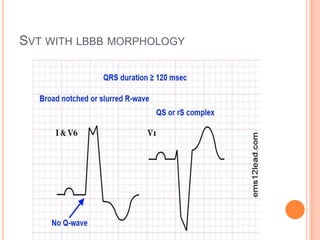 wide complex tachycardia | PPTX