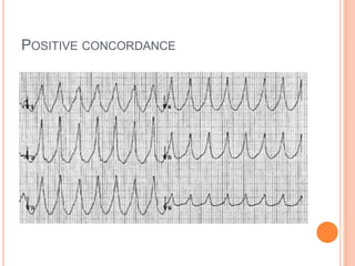 wide complex tachycardia | PPTX