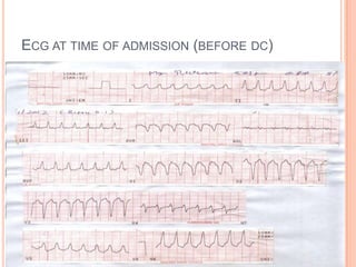 wide complex tachycardia | PPTX