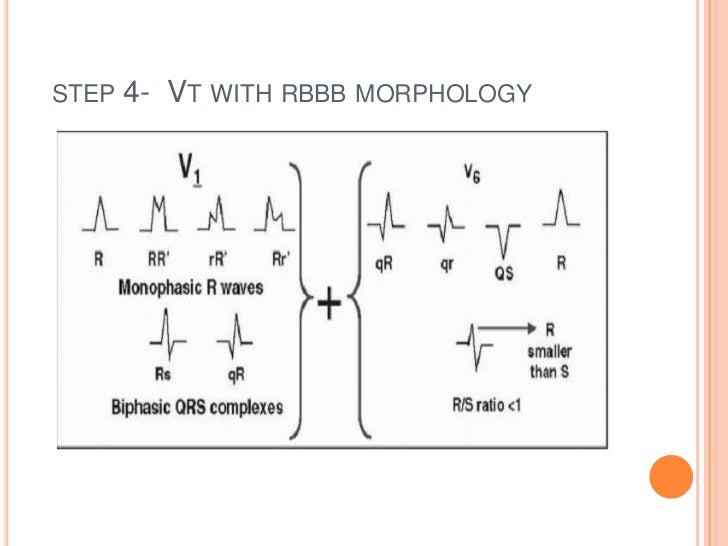 wide complex tachycardia