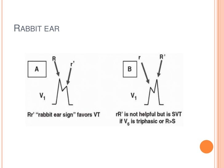 wide complex tachycardia