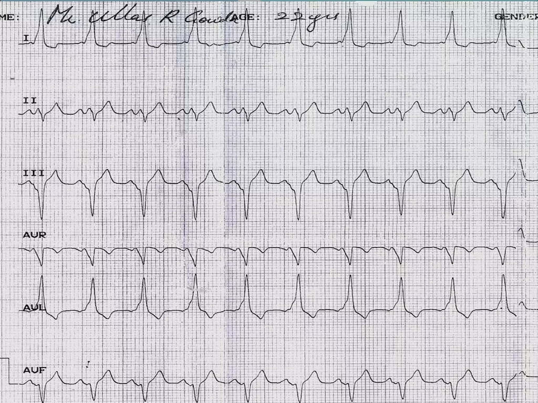 ECG: Wolff-Parkinson-White syndrome | PPT