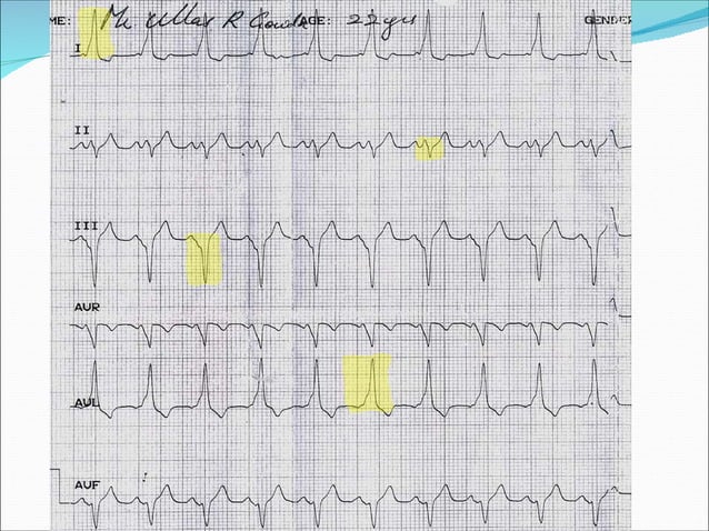 ECG: Wolff-Parkinson-White syndrome | PPT