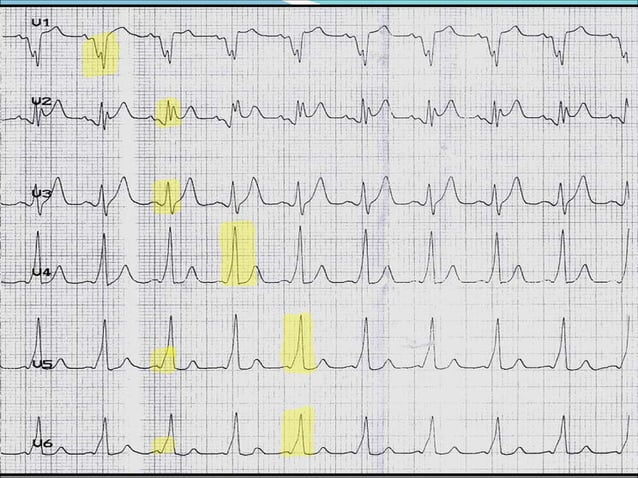 ECG: Wolff-Parkinson-White syndrome | PPT