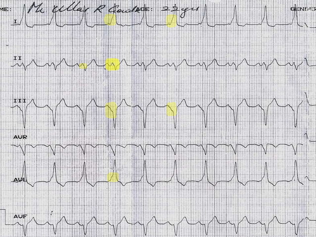 ECG: Wolff-Parkinson-White syndrome | PPT