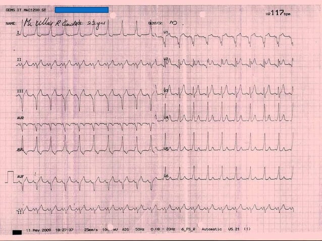 ECG: Wolff-Parkinson-White syndrome | PPT