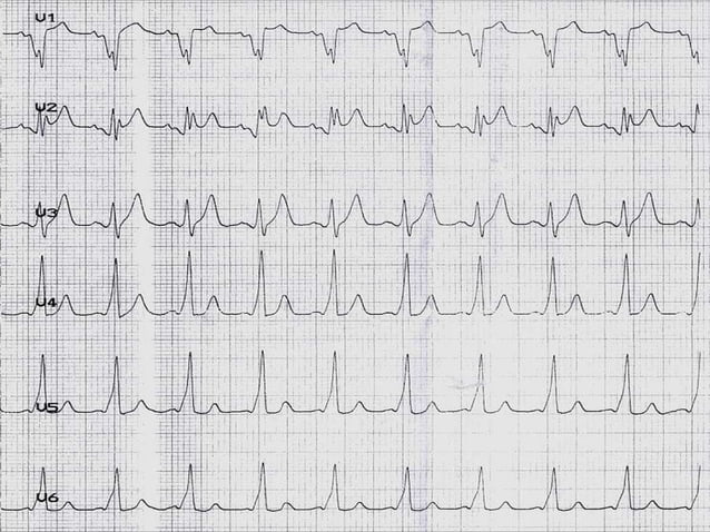 ECG: Wolff-Parkinson-White syndrome | PPT