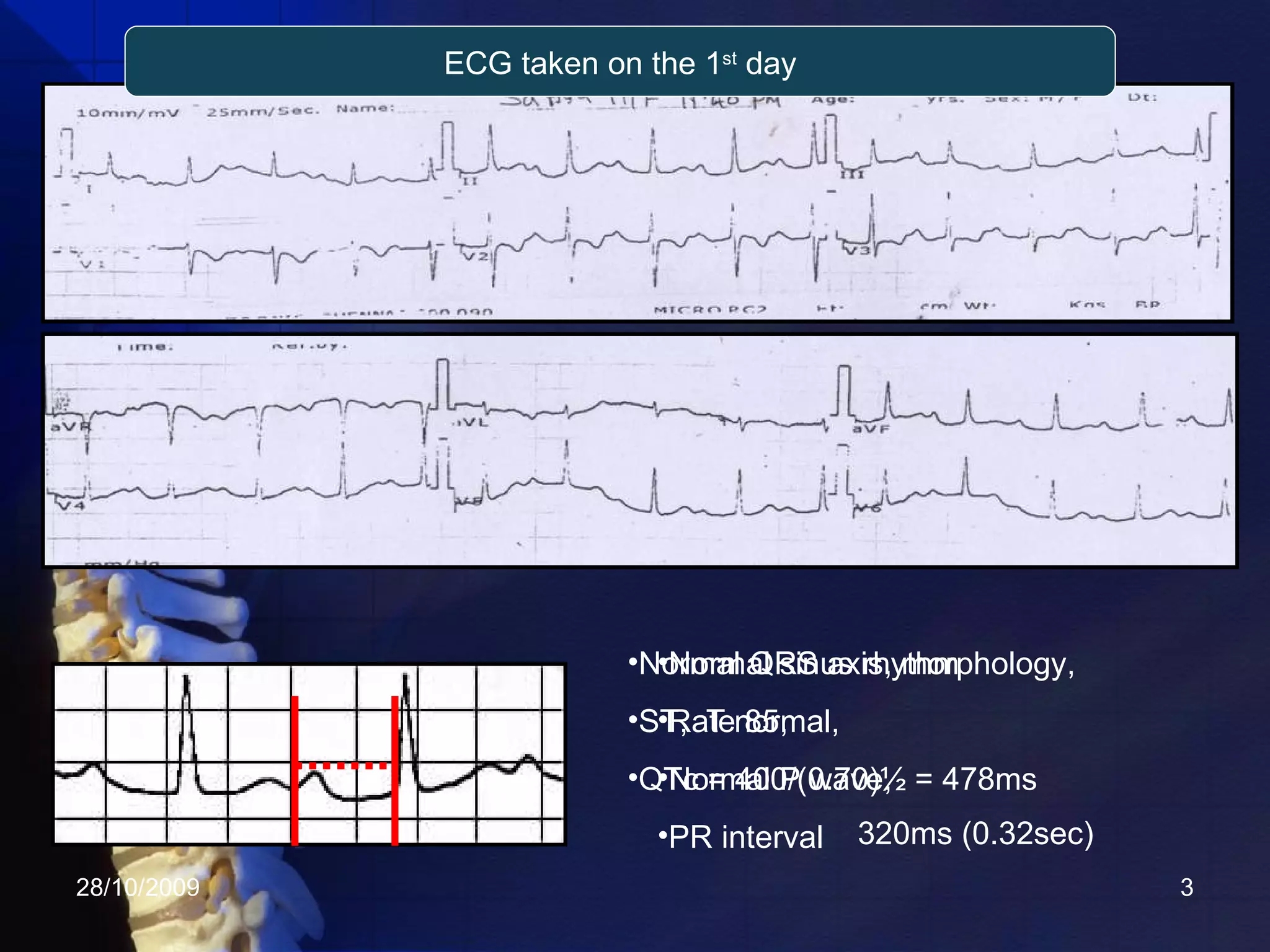 ECG: Toxin induced First degree Heart Block | PPT