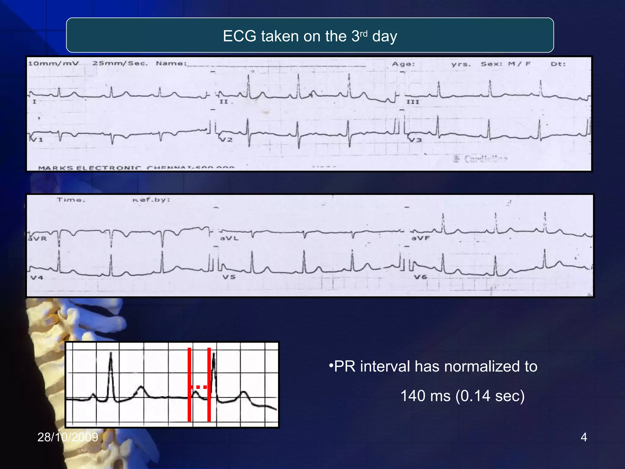 ECG: Toxin induced First degree Heart Block | PPT