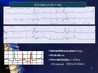ECG: Toxin induced First degree Heart Block | PPT