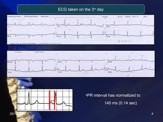 ECG: Toxin induced First degree Heart Block | PPT