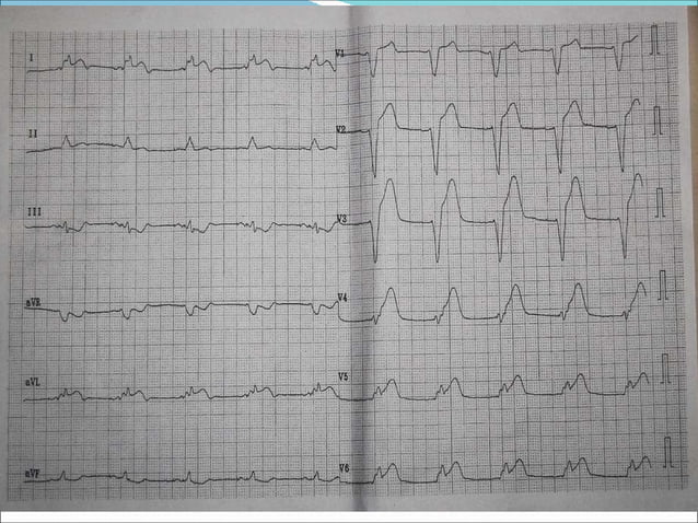 ECG: Multifocal Atrial Tachycardia | PPT