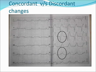 ECG: Multifocal Atrial Tachycardia | PPT