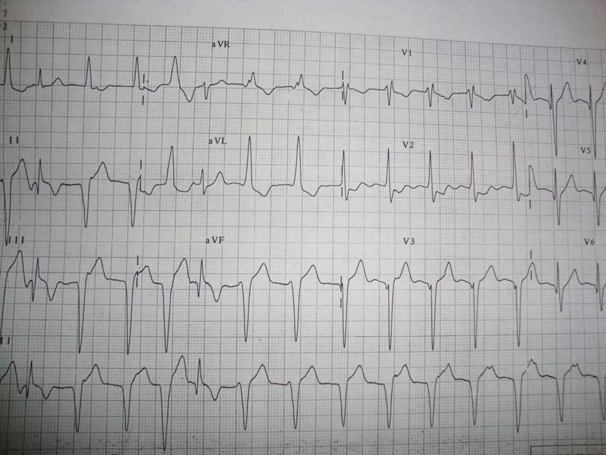 ECG: Accelerated Idioventricular Rhythm | PPT