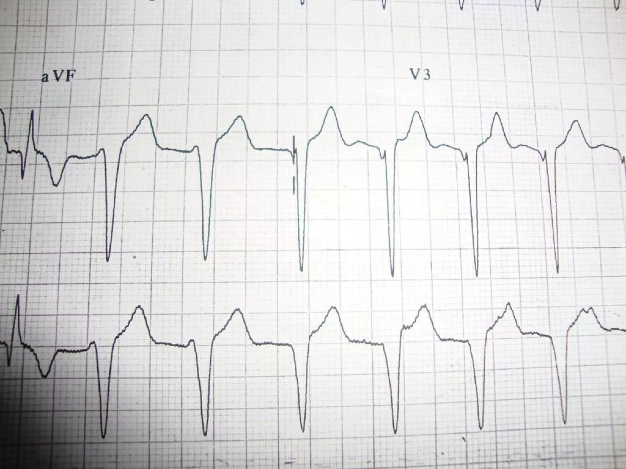 ECG: Accelerated Idioventricular Rhythm | PPT