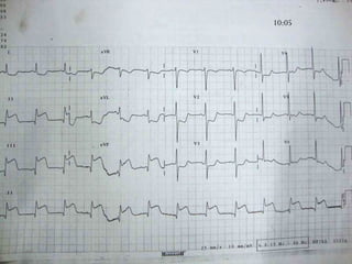 ECG: Accelerated Idioventricular Rhythm | PPT