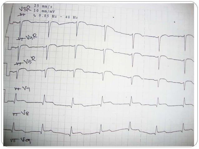 ECG: Accelerated Idioventricular Rhythm | PPT