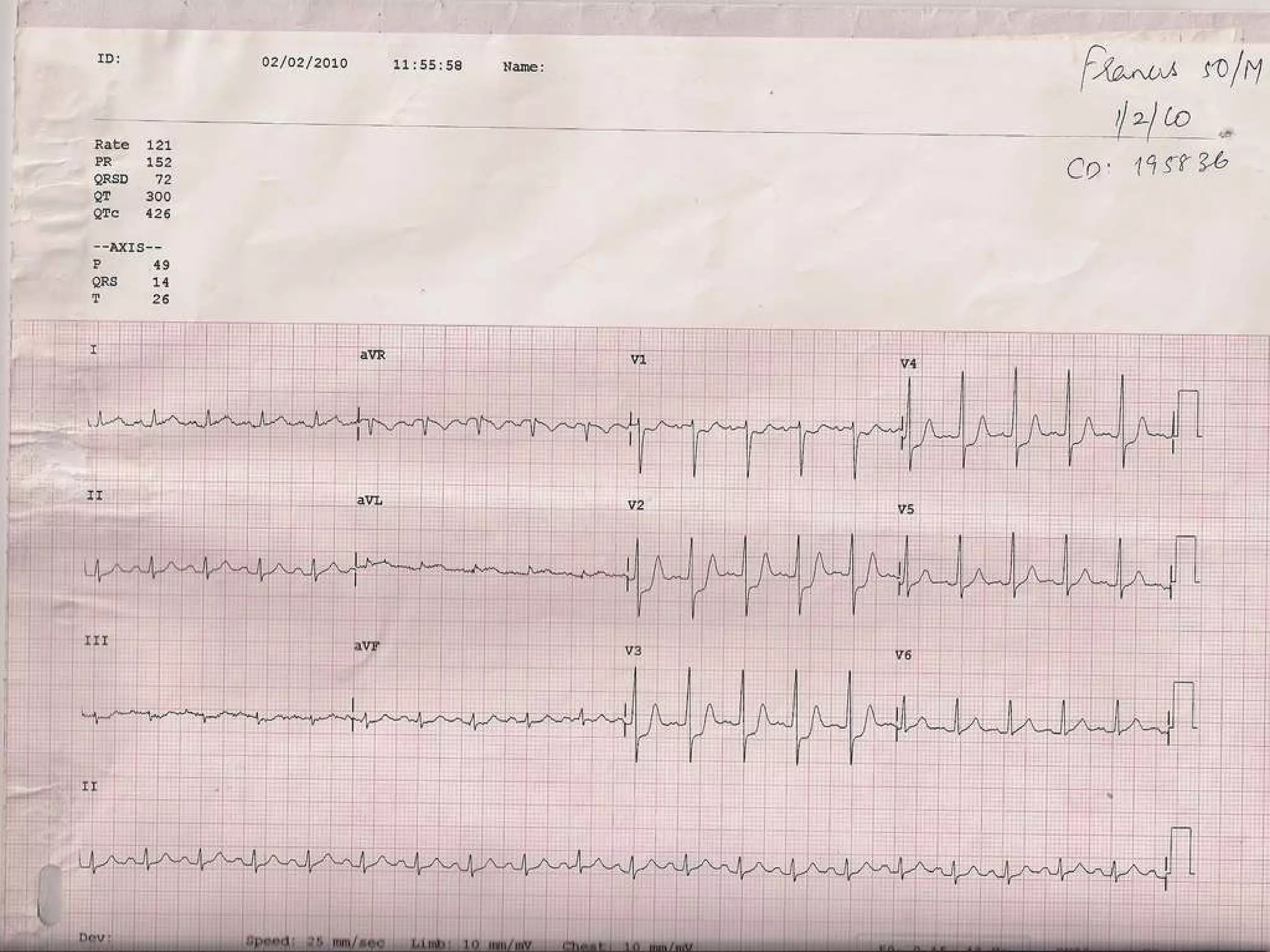 An Interesting ECG for Discussion | PPT | Heart and Cardiovascular ...