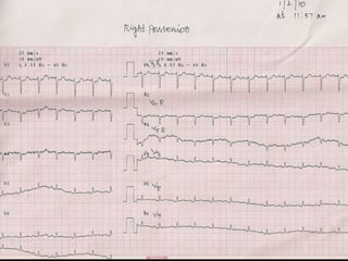 An Interesting ECG for Discussion | PPT